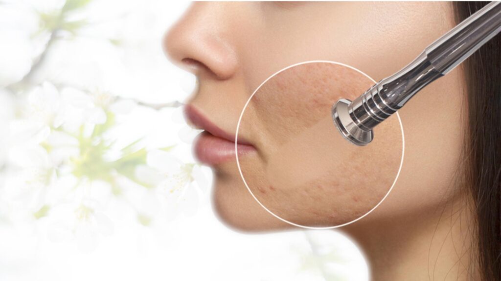 Removal of scars, burns, spots, stretch marks, freckles and ...